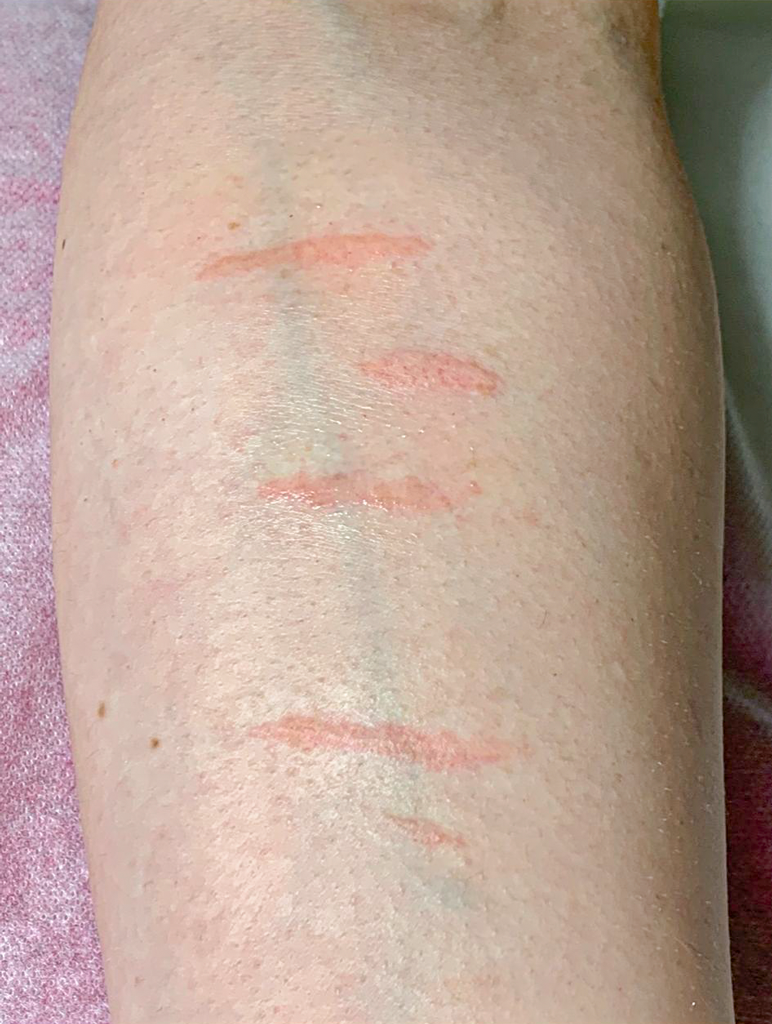 Narben PMU - M. Bellmann Academy